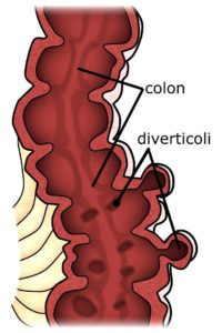 diverticolo | KINESIOPATIA