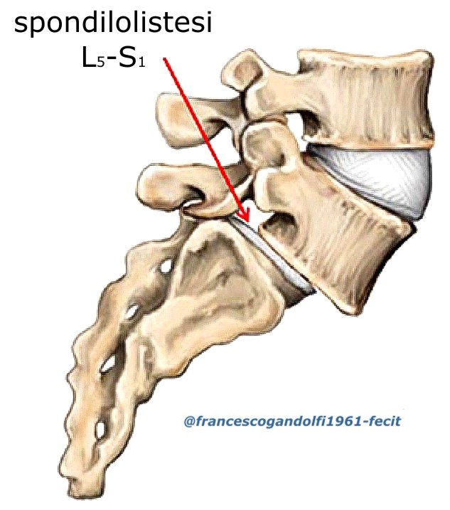 articolazione lombo-sacrale | KINESIOPATIA